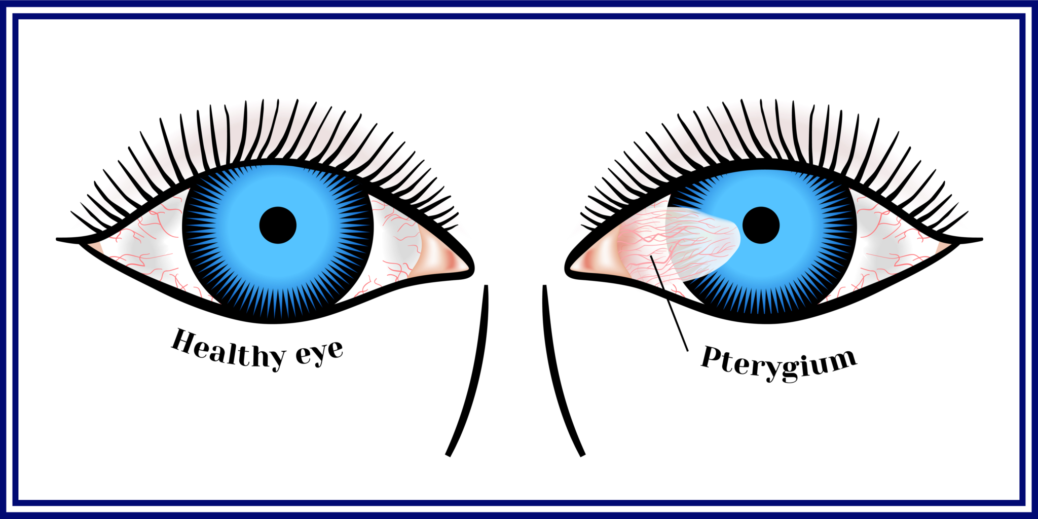 Pterygium | Mountain Valley Eye | Eye Care Park City - Mountain Valley ...