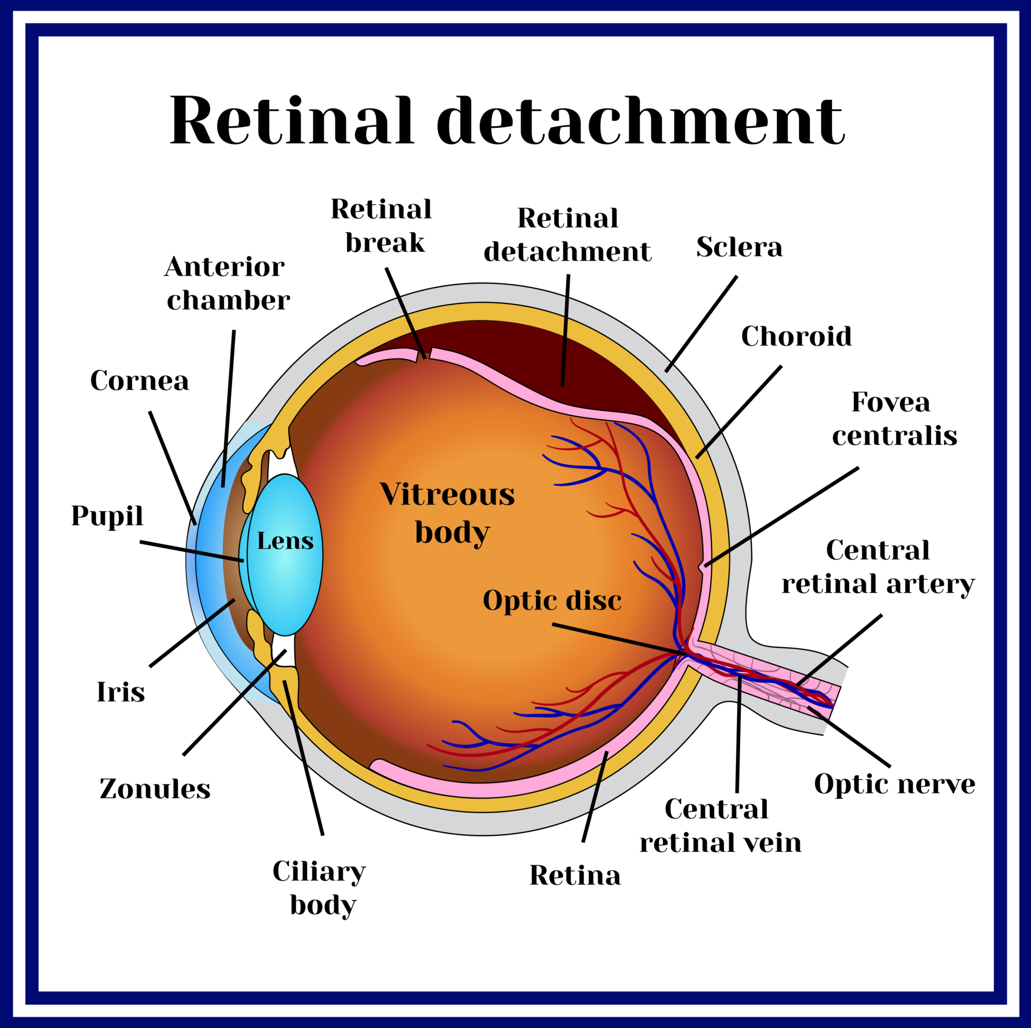 Detached and Torn Retina | Mountain Valley Eye | Retina Care Park City ...