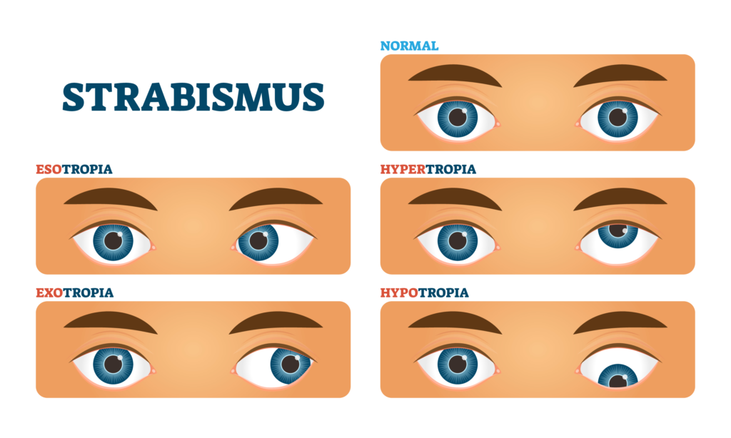 Strabismus - Mountain Valley Eye Institute - Mountain Valley Eye Institute