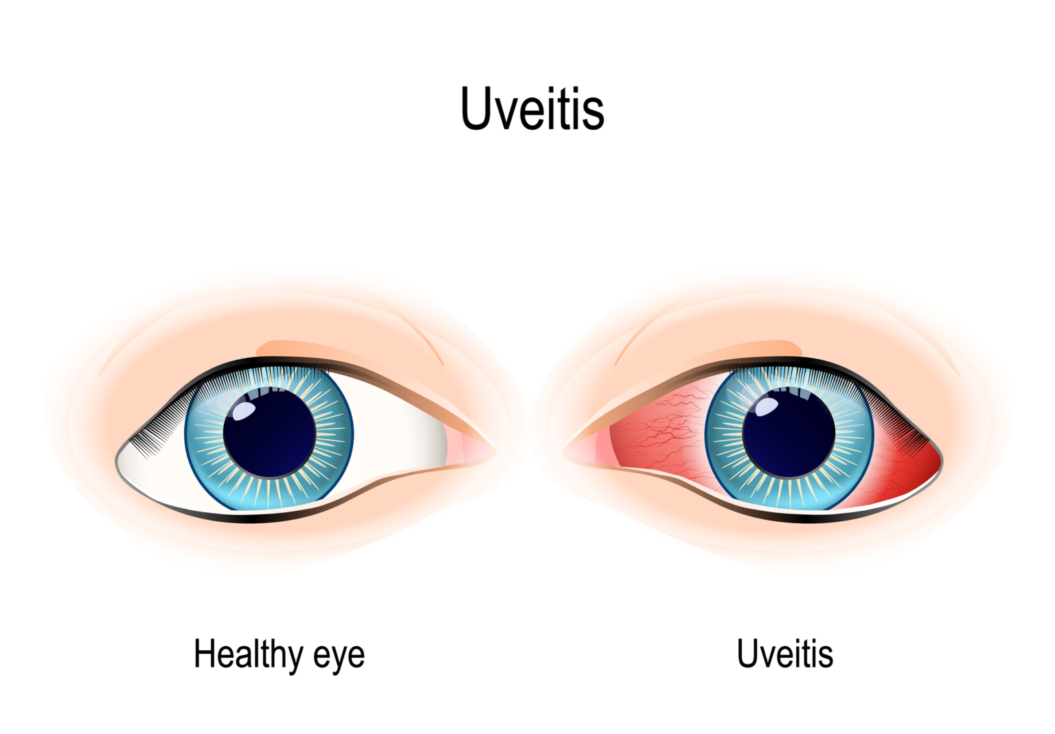 Uveitis | Mountain Valley Eye | Eye Care Park City - Mountain Valley ...
