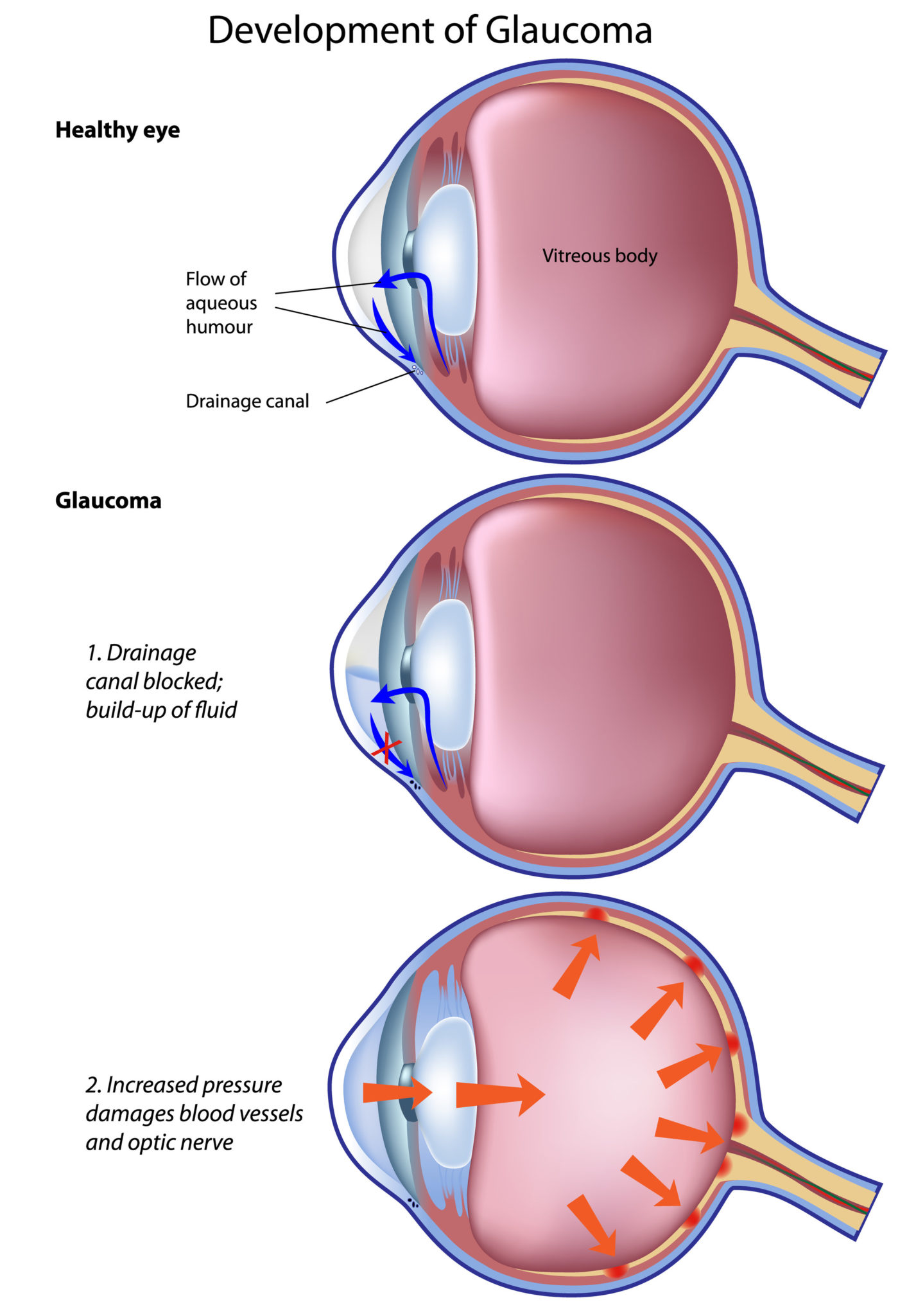 What is Glaucoma / Symptoms - Mountain Valley Eye Institute | Glaucoma ...